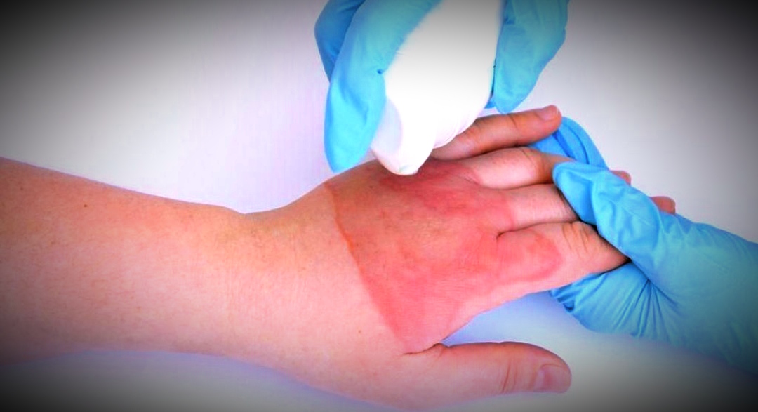 Dua Bocah SD Alami Luka Bakar, Diduga Main Api dan Spiritus – Benuanta